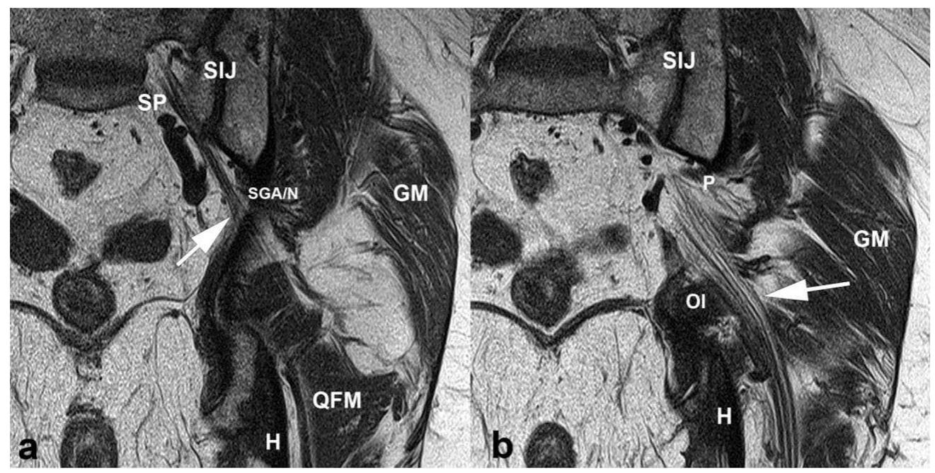 Sp sacral plexus, sga/n superior gluteal artery and nerve,