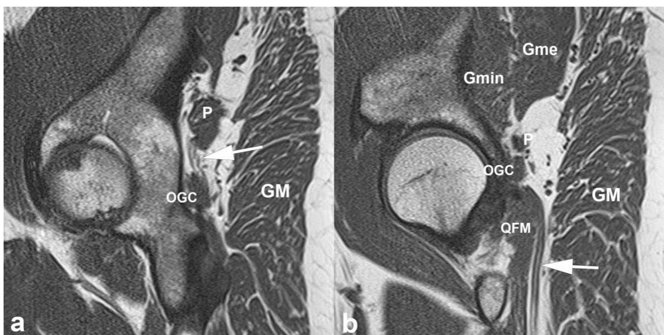 Normal anatomy of the subgluteal space. consecutive from