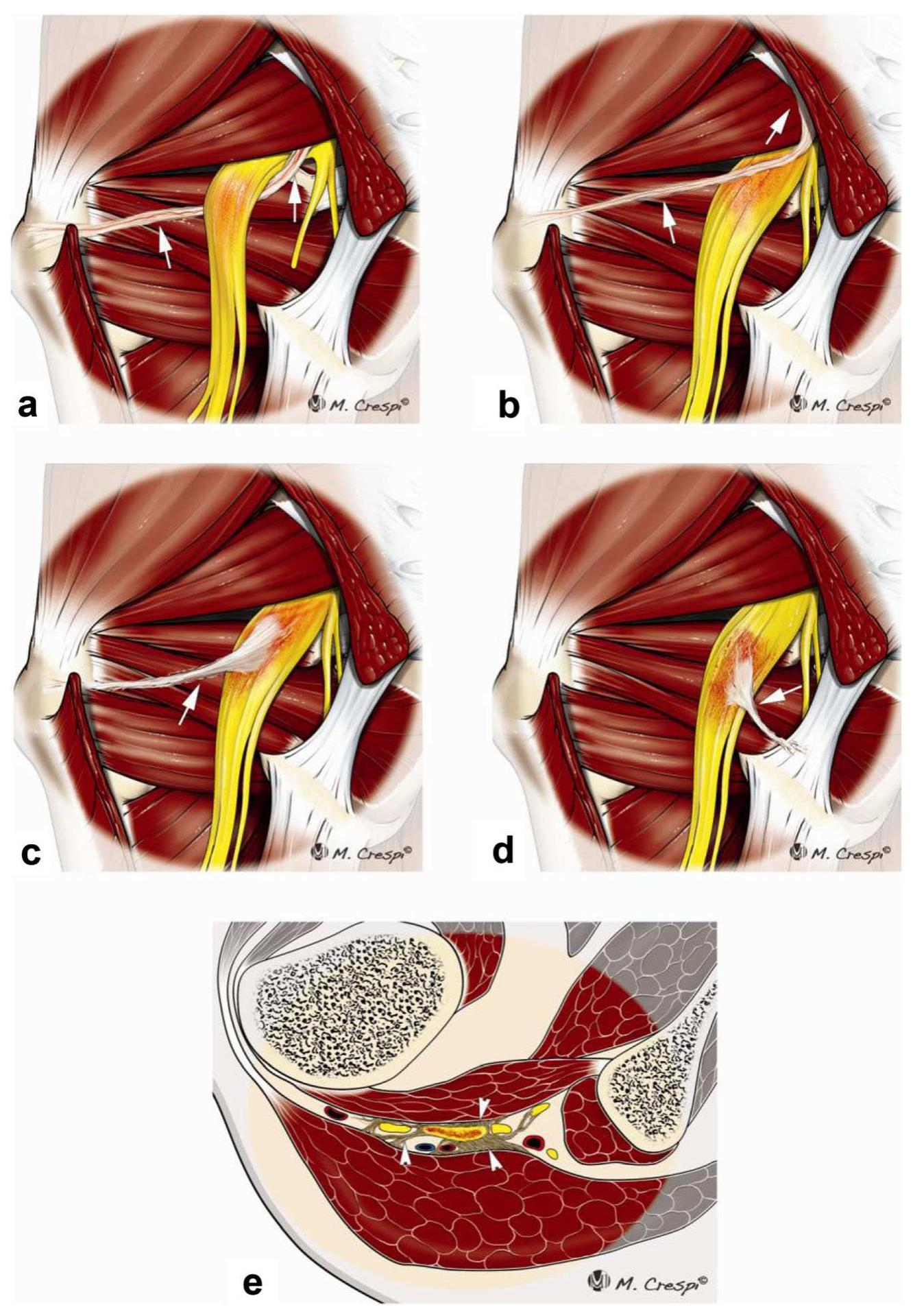 Greater sciatic notch, distal, which affect it in the