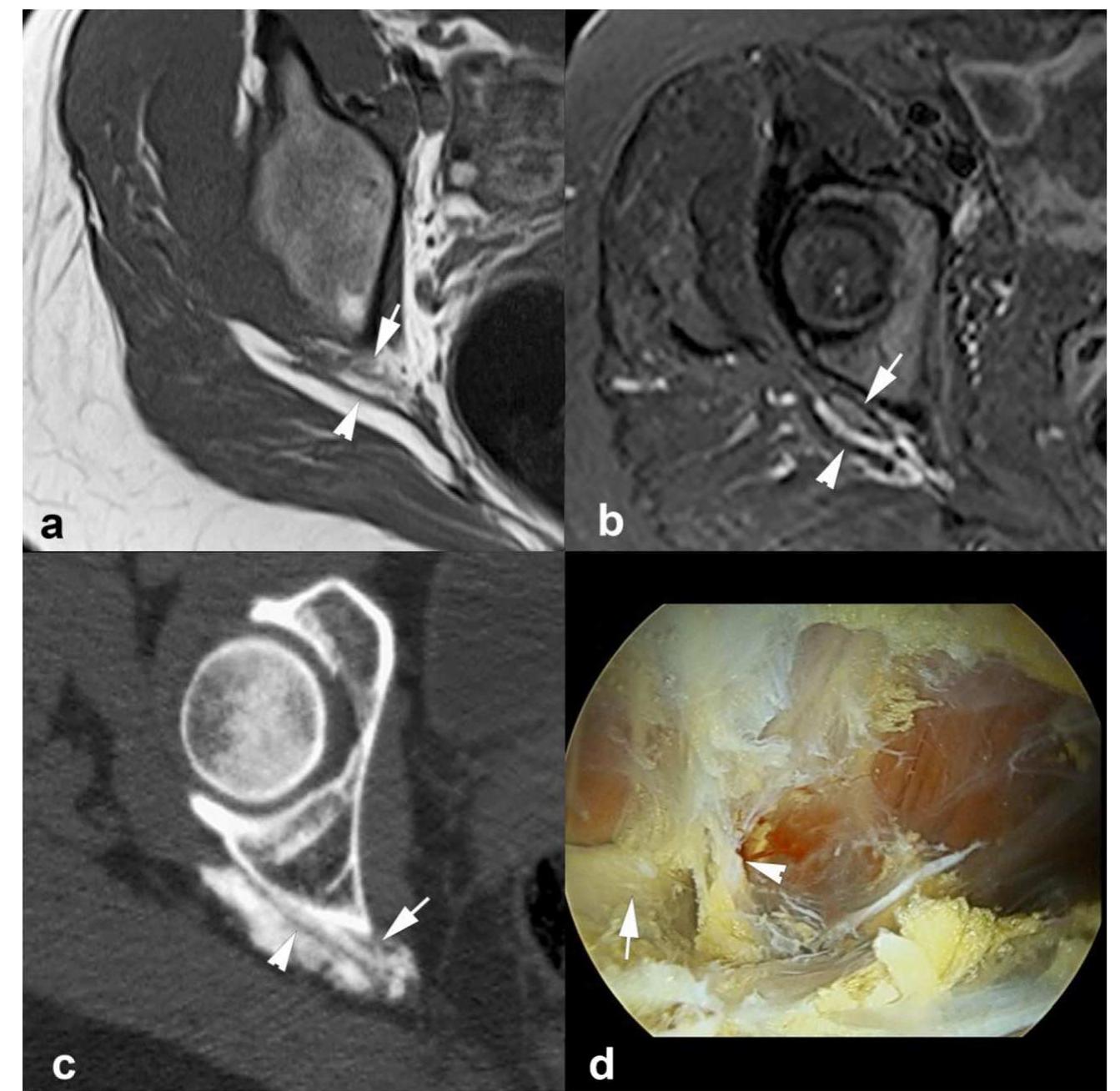 Figure 11 - Deep gluteal syndrome: anatomy, imaging, and