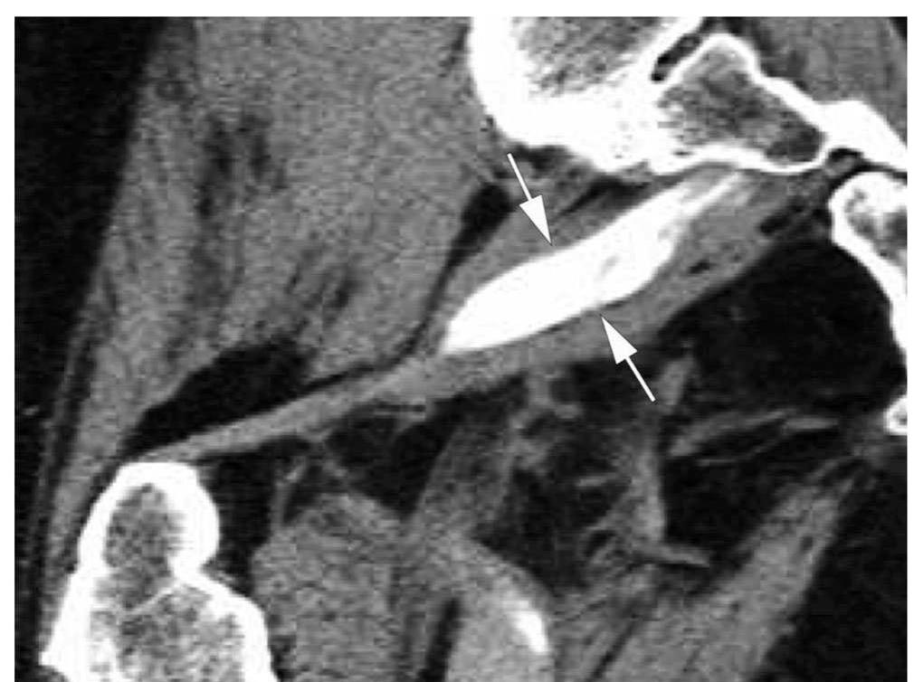 Botox infiltration. sagittal-oblique mdct reconstruction