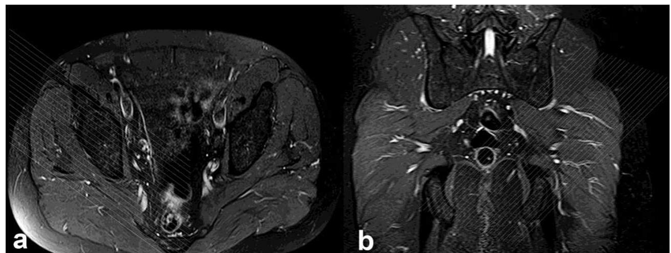 (b) perpendicular to the axis of the piriformis muscle on a