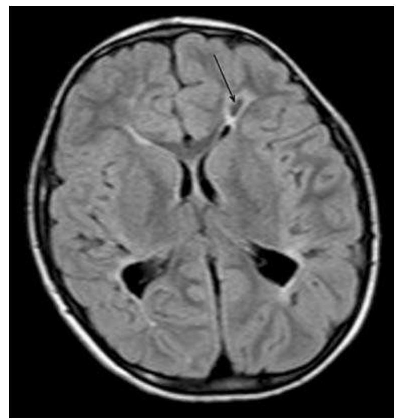 Periventricular leukomalacia. cerebral mri of a 7-year-old
