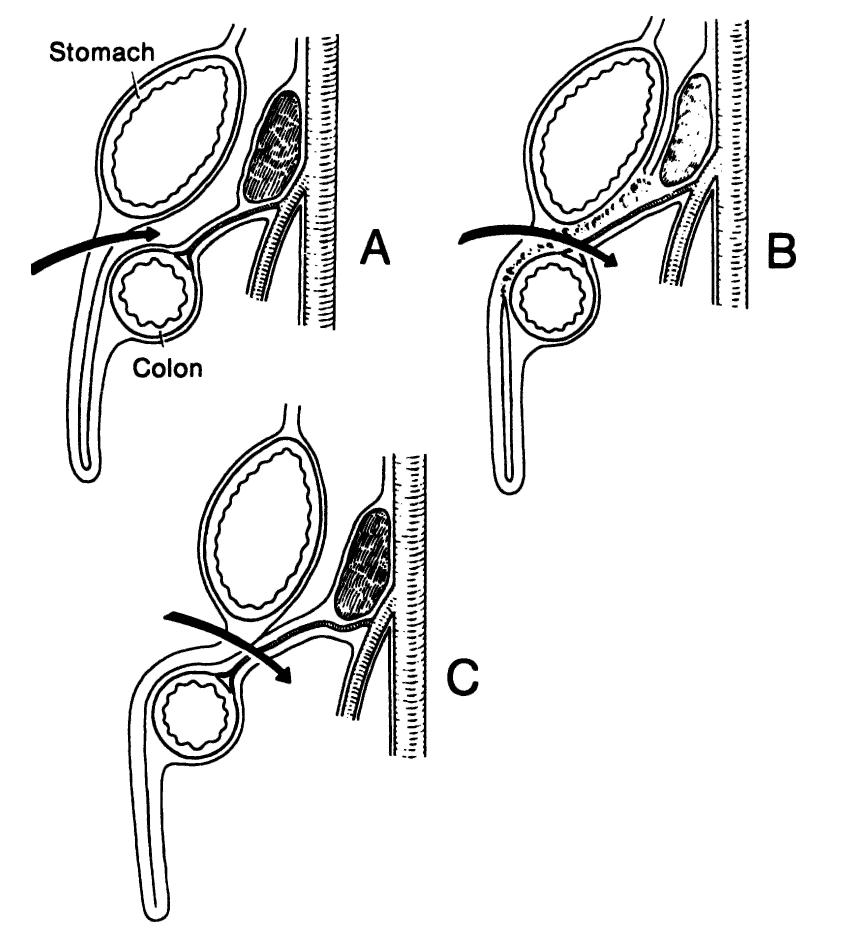 26. entrance to the lesser sac. a. normal anatomy. the arrow