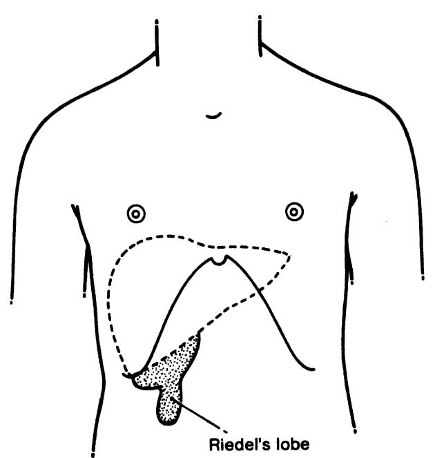 7. riedel’s lobe of the liver. this anomalous lobe is found