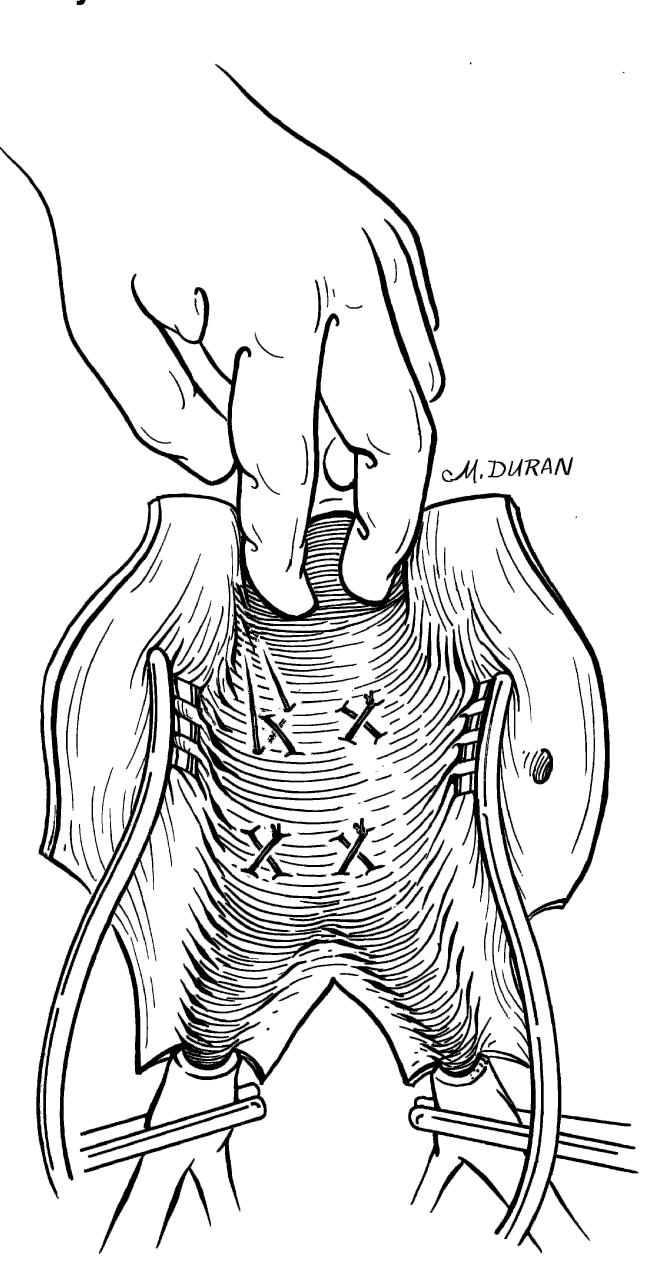 14. ligation of back-bleeding lumbar arteries with