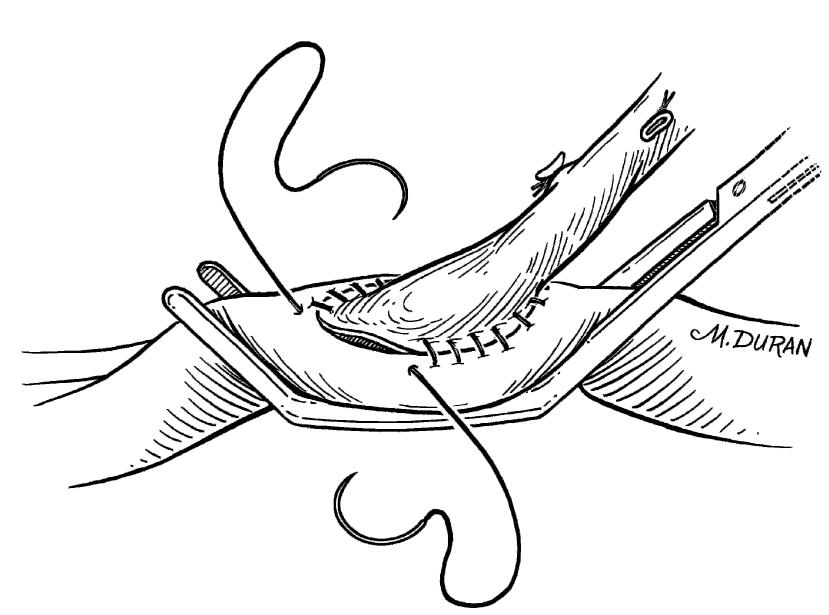 22. end-to-side anastomosis of spatulated vein to below-knee