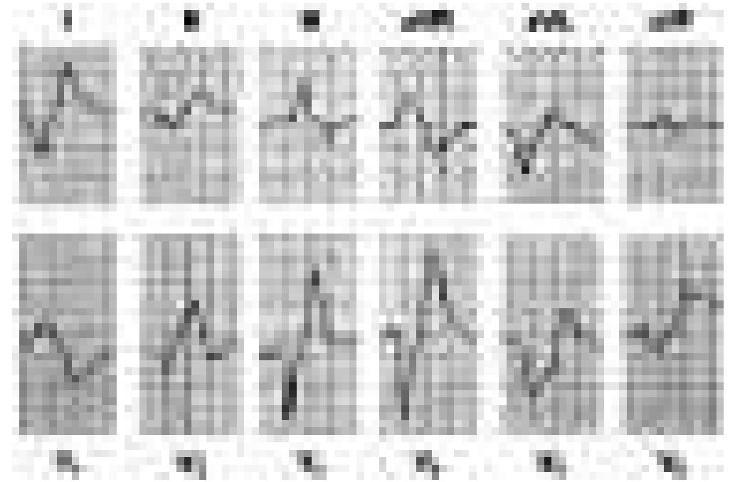 : electrocardiogram (ecg) of a patient with severe