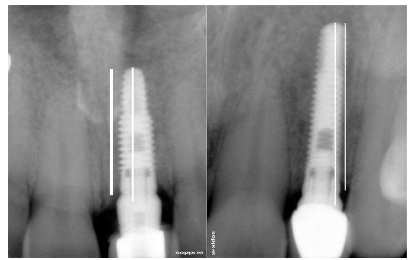 Figure 6 - from Clinical and Radiographic Evaluation of