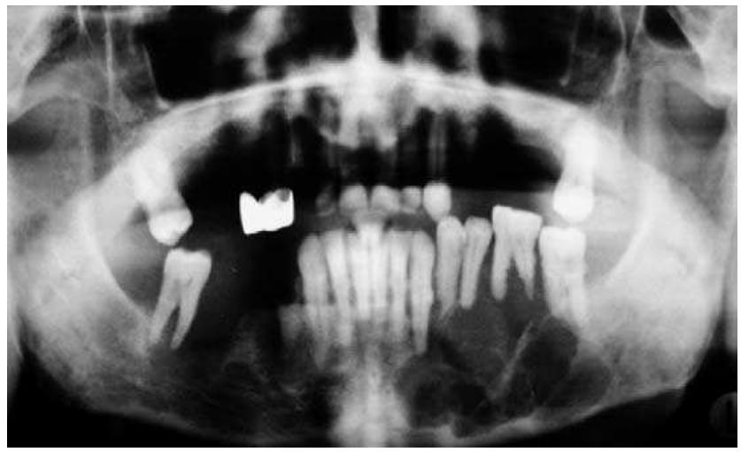 Panoramic radiograph showing osteolytic lesions in the right
