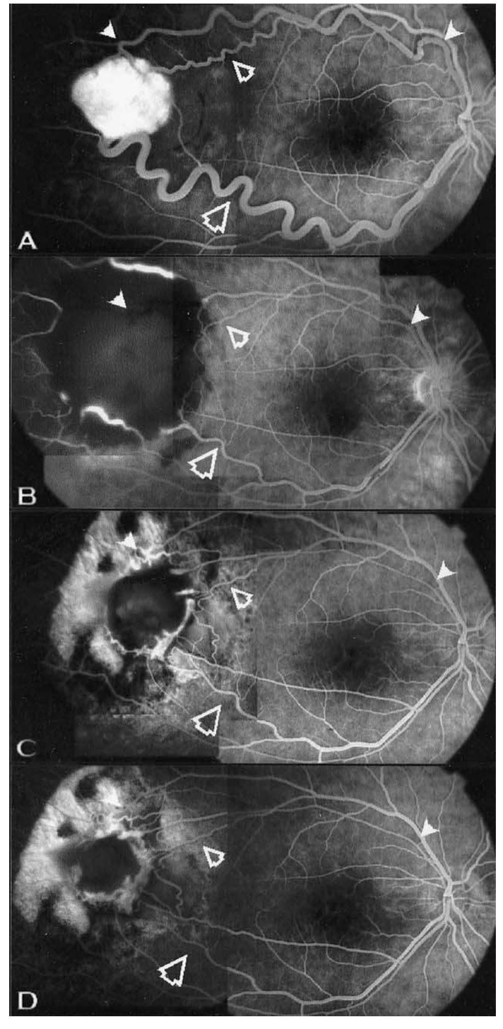 Figure 1 - Retinal capillary hemangioma treatment by