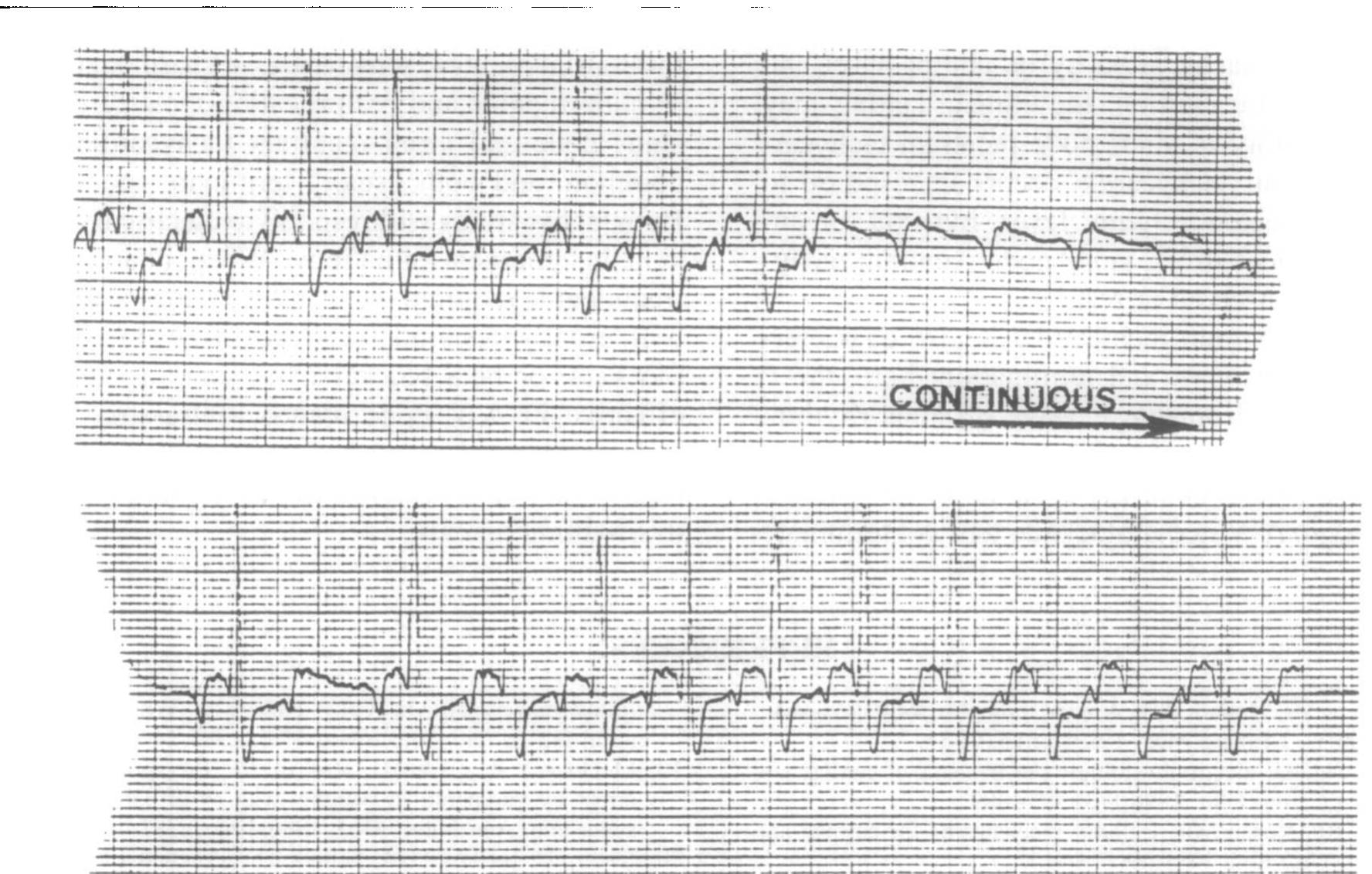 Intra-atrial reentry tachycardia. note persistence of the