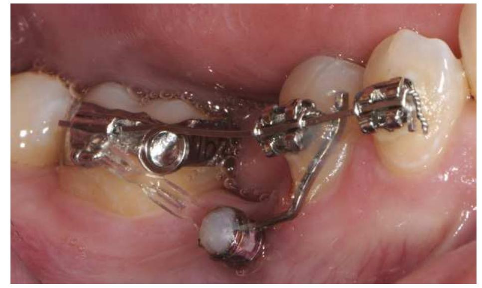 Uprighting of a tilted mandibular molar with orthodon- tic