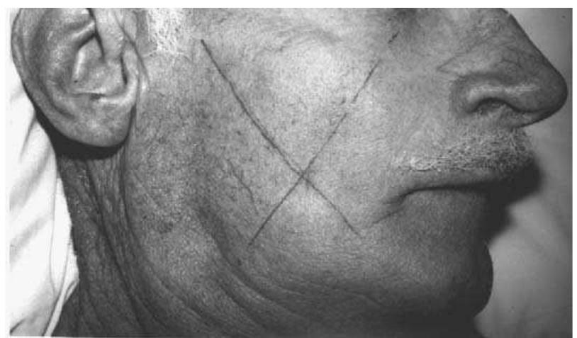 Guide lines on the patient’s face help to orient the needle