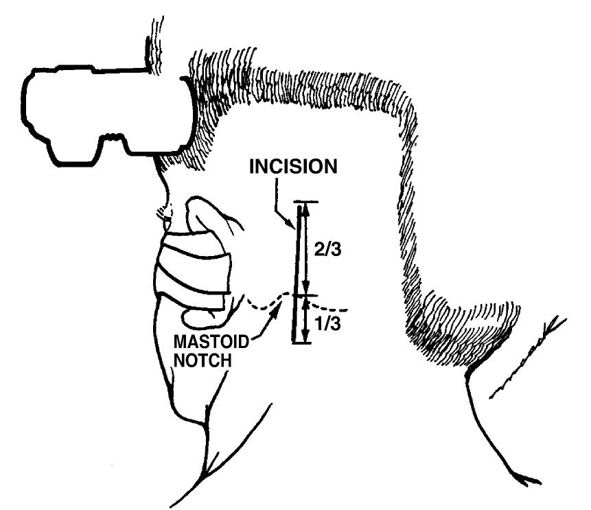 Location of the surgical incision. the external ear is taped