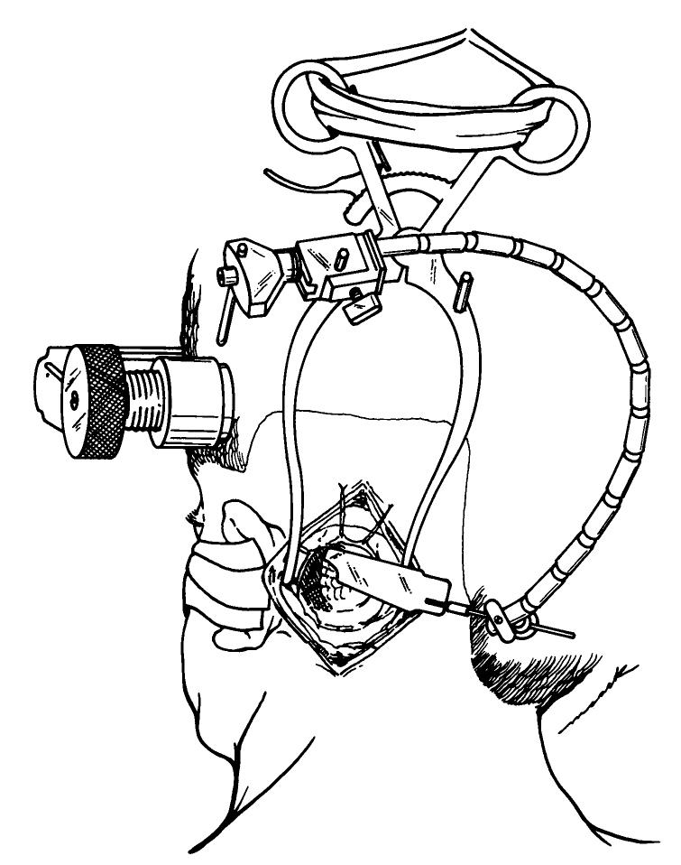 Position of the self-retaining retractor. note fixation of