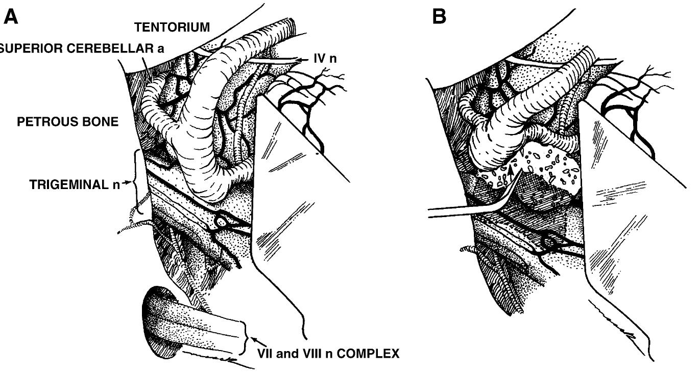 Illustration of a left trigeminal nerve decompression. (a)