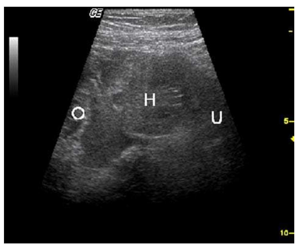 Transvaginal ultrasound examination of the pelvis