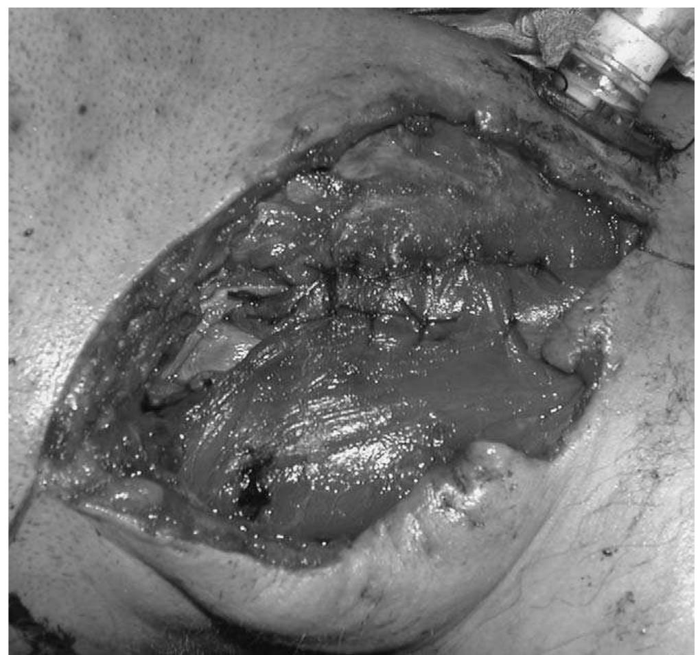 Intraoperative picture. the anterior border of the residual