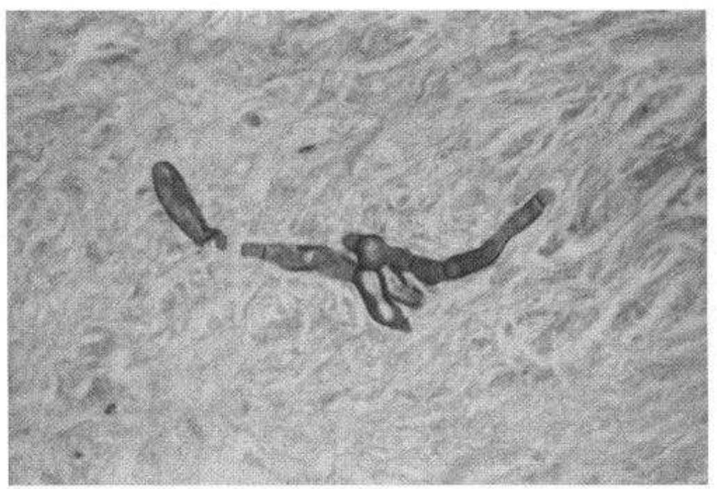 Case 1. hyphal elements in the ocular tissue (stain, gomor