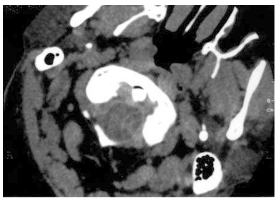 Axial ct scan of the atlantoaxial region in soft tissue