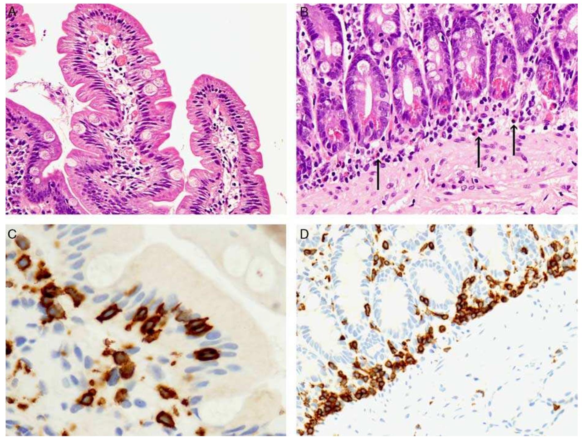 Histologic findings in duodenal mucosa sections from ncgs