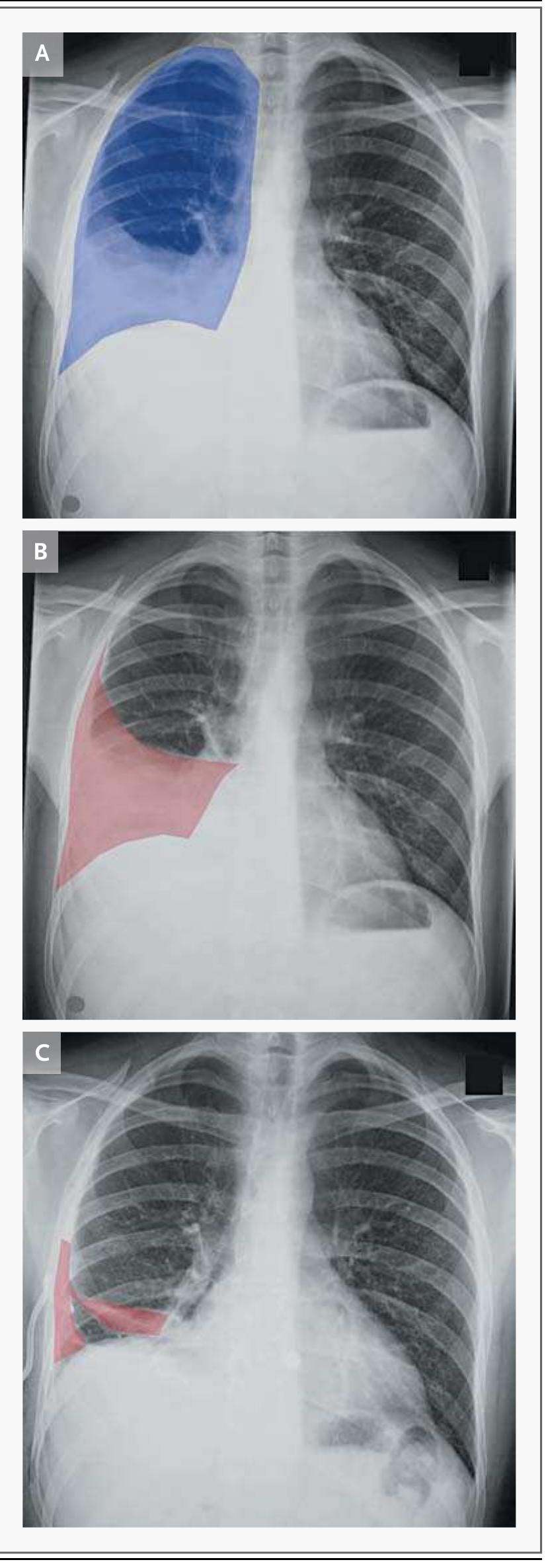 (PDF) The second multi-centre intra-pleural sepsis trial (MIST2), to ...