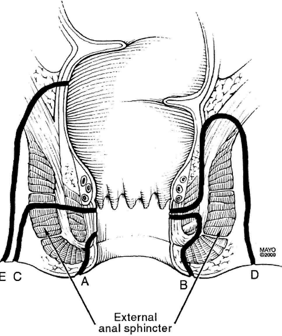 The parks classification. (a) a superficial fistula tracks