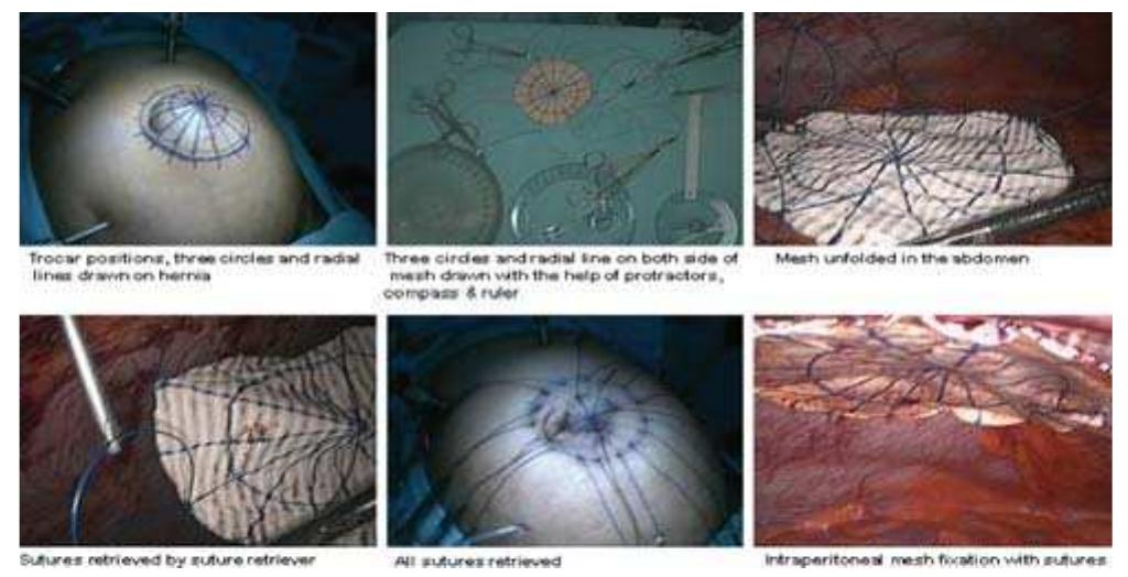 Laparoscopic suture repair of ventral hernia conclusions: