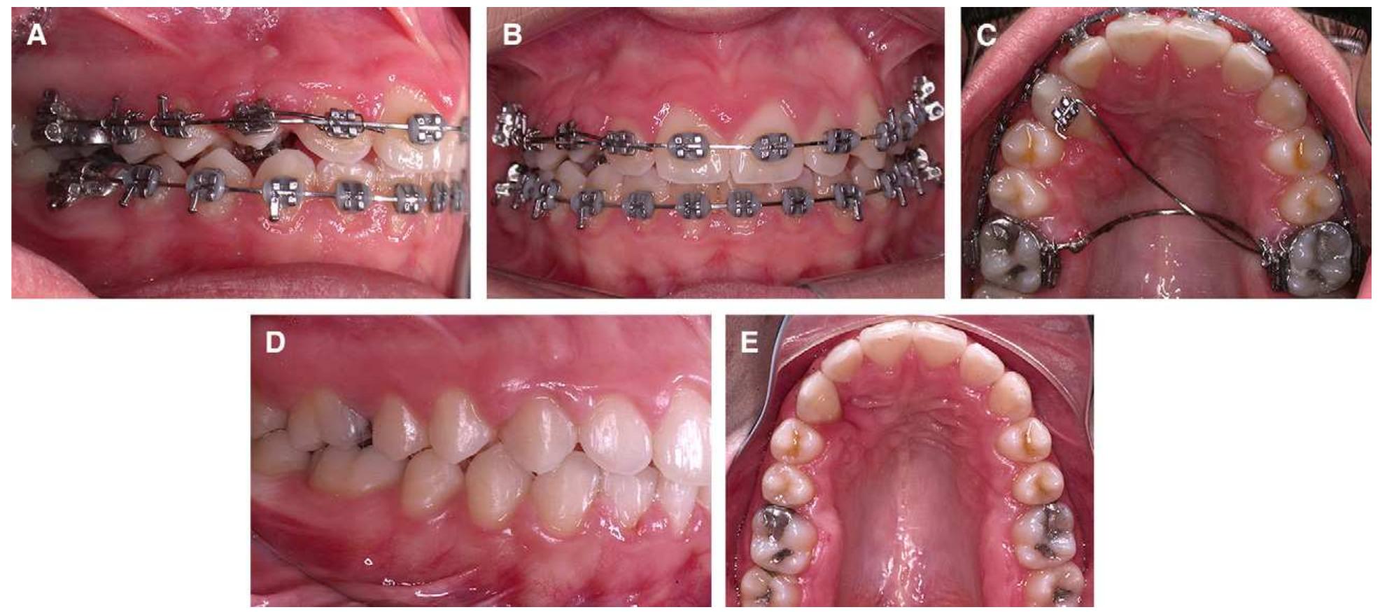 Continuous torque system in the maxillary arch to correct