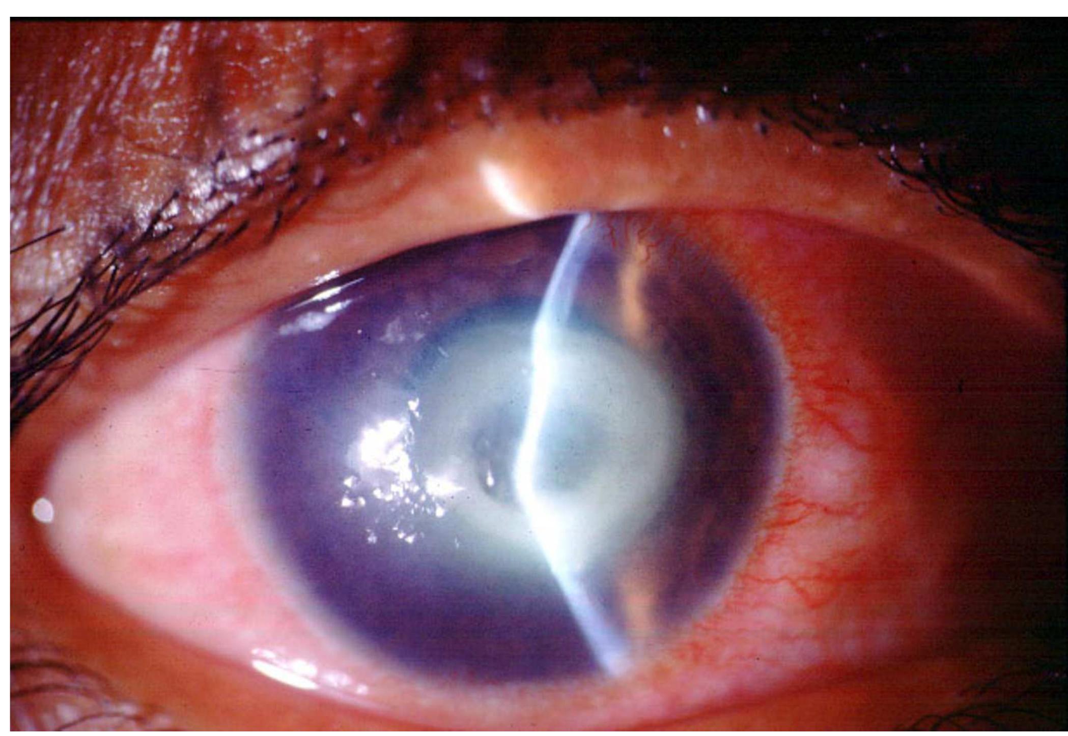 Slit lamp biomicroscopy of cornea of case 3 in diffuse