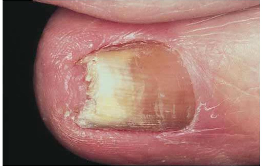 Severe incurvated medial and lateral nail plates (pincer