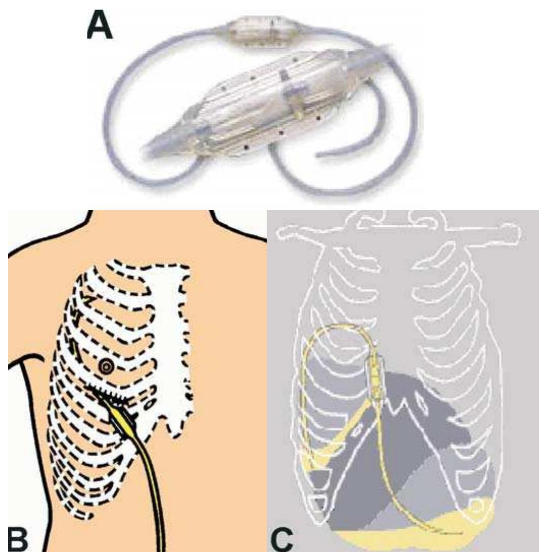 pleuroperitoneal shunt”: a) catheter with interposed