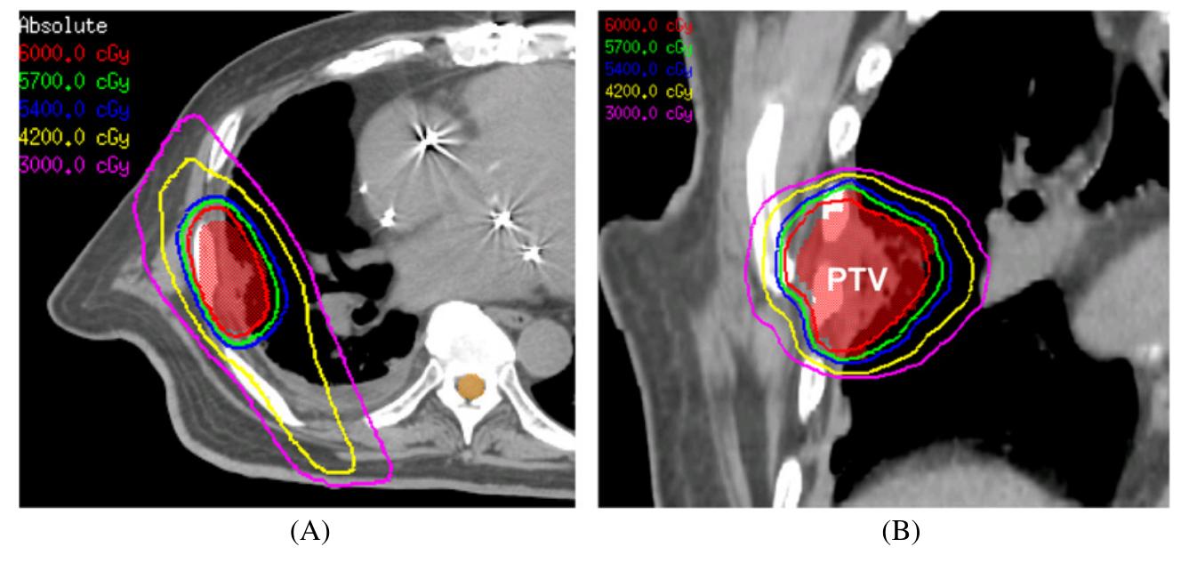 Isodose plot for the anatomy-based vmat plan for a lung