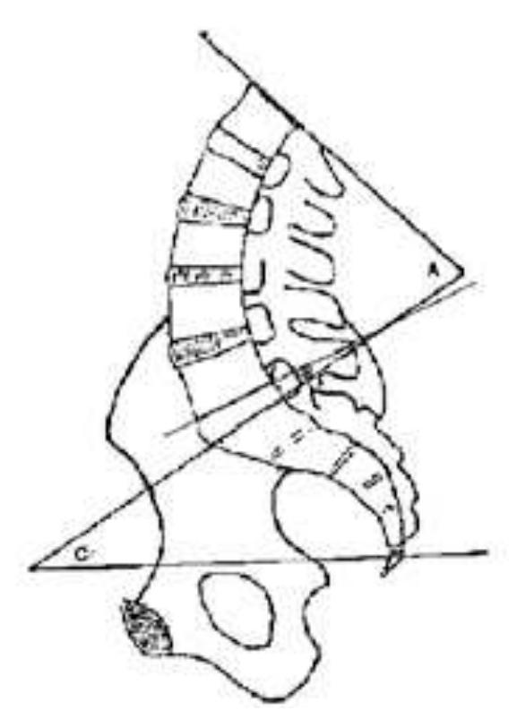diagram of lateral view of the lumbar spine. a: angle of