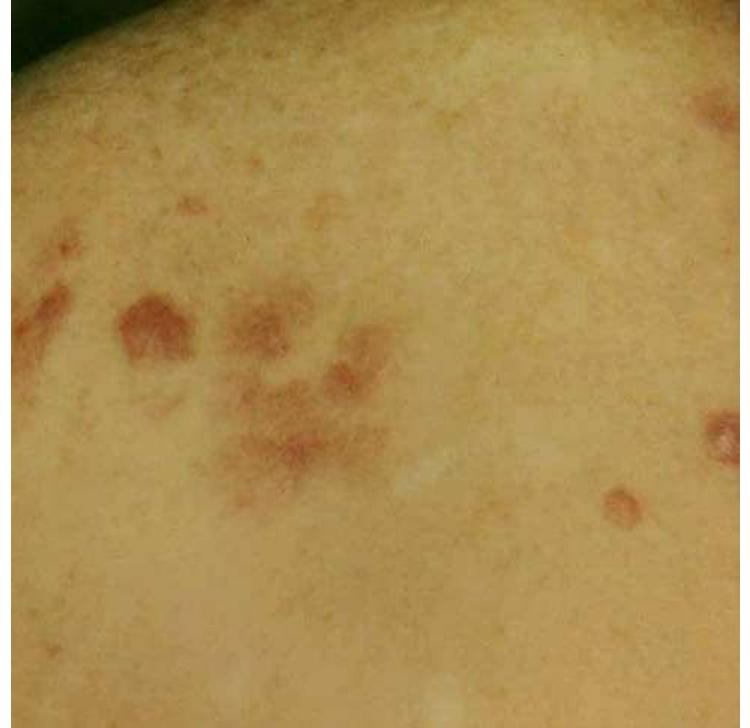 Skin lesions of pseudolymphoma on the back.