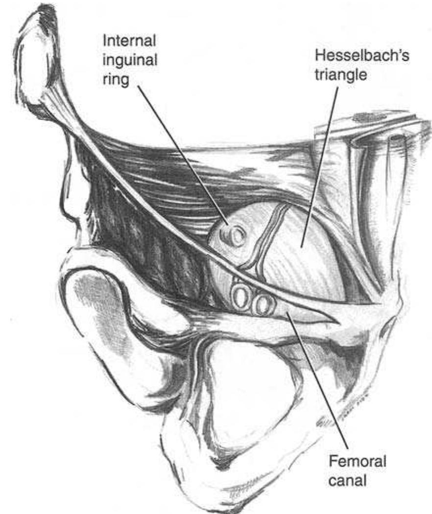4. indirect inguinal hernias occur through the internal