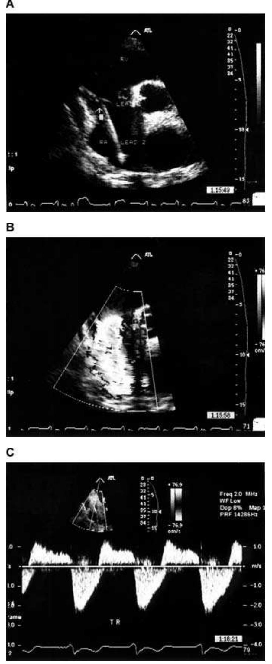 (a) parasternal short axis view showing the two pacemaker