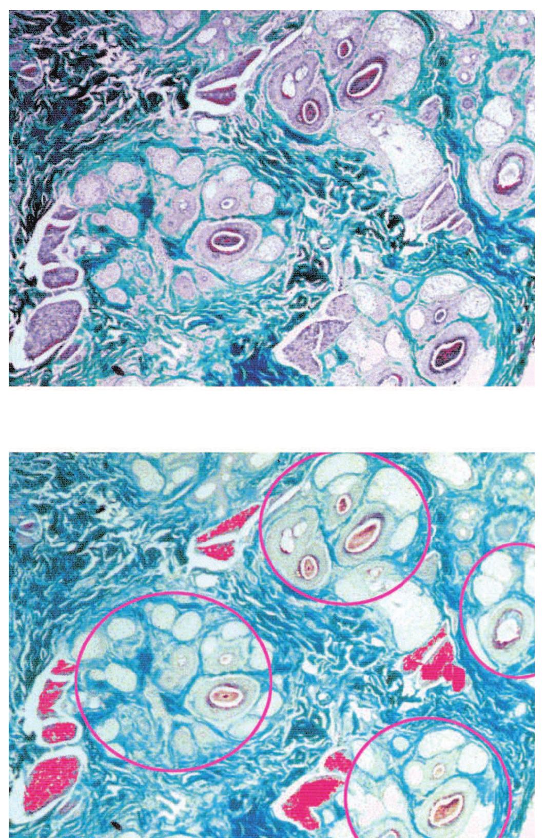 (PDF) The Arrector Pili Muscle and the Follicular Unit of the Scalp: A ...