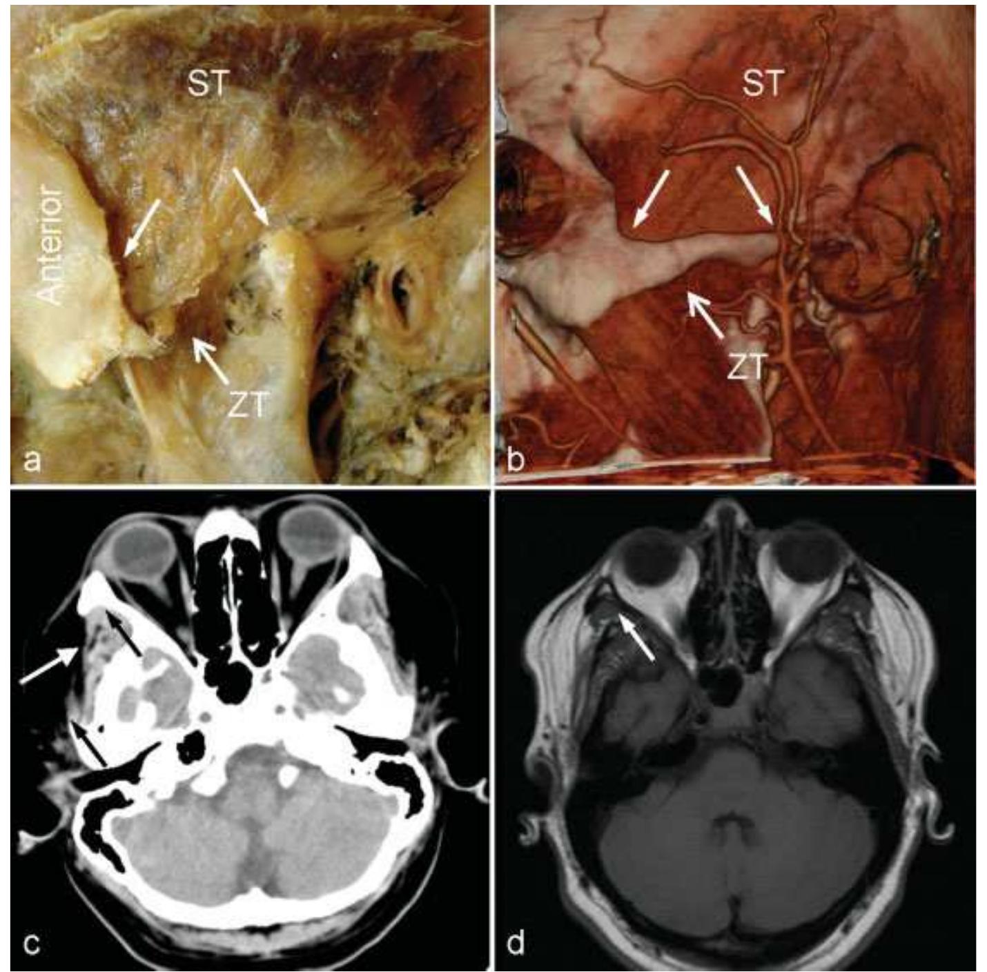 Part into the anterior and posterior temporal fossa. large