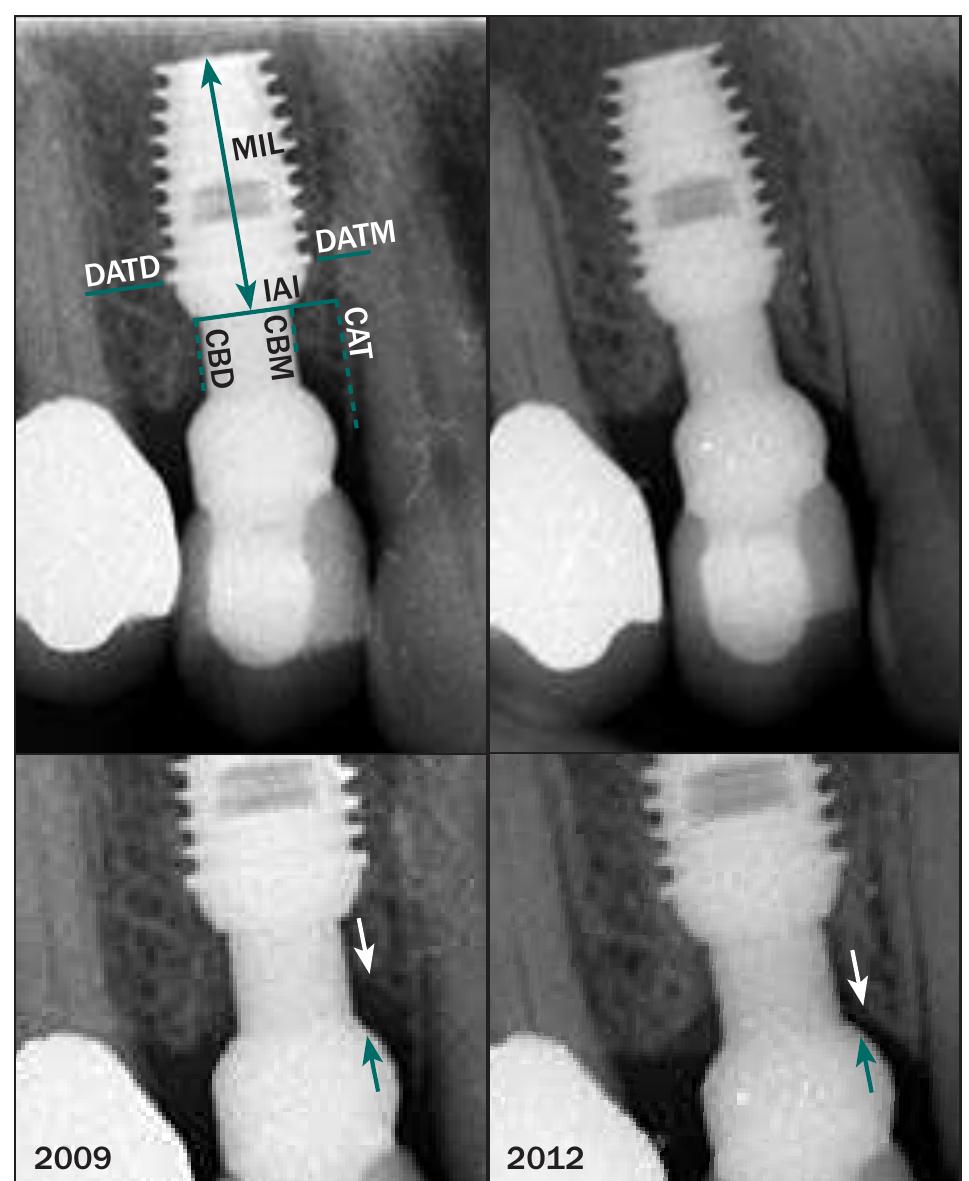 Periapical radiographs of a plateau root-form implant re-