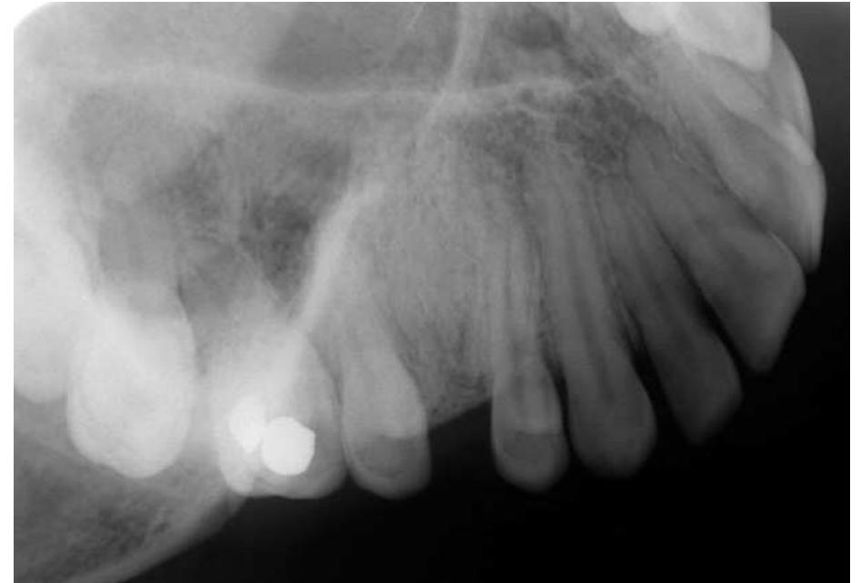 Case 2. oblique radiographic projection of the right maxilla