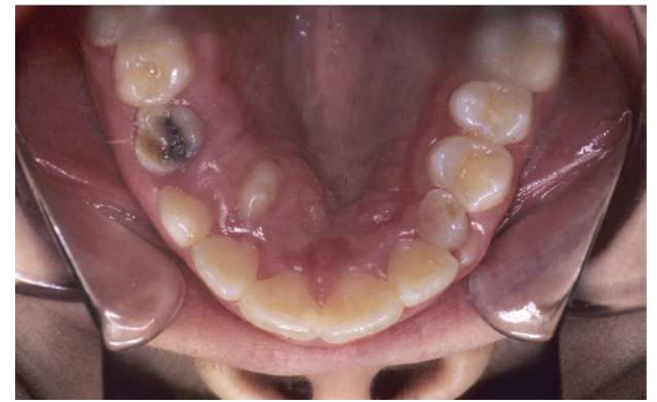 Case 3. the appearance of the patient’s maxilla at age 11