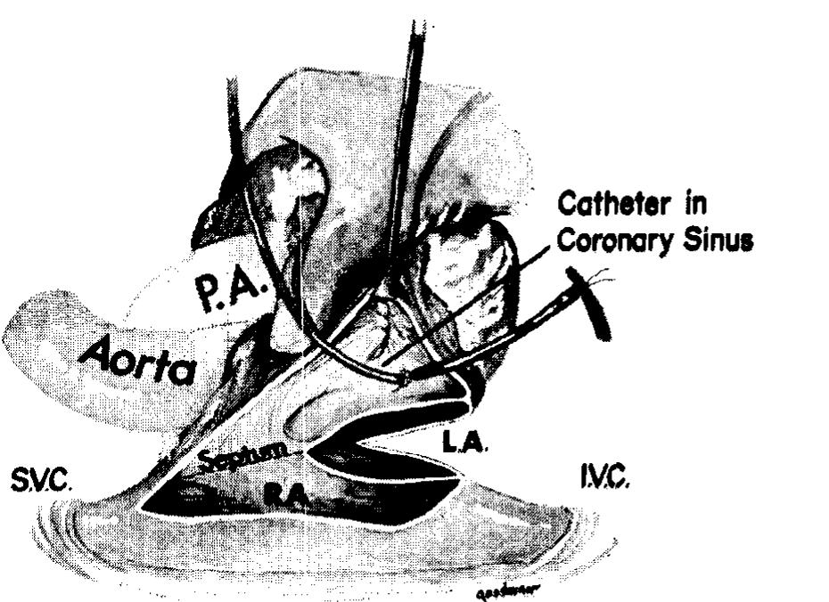 Excision of donor heart. the catheter for retrograde