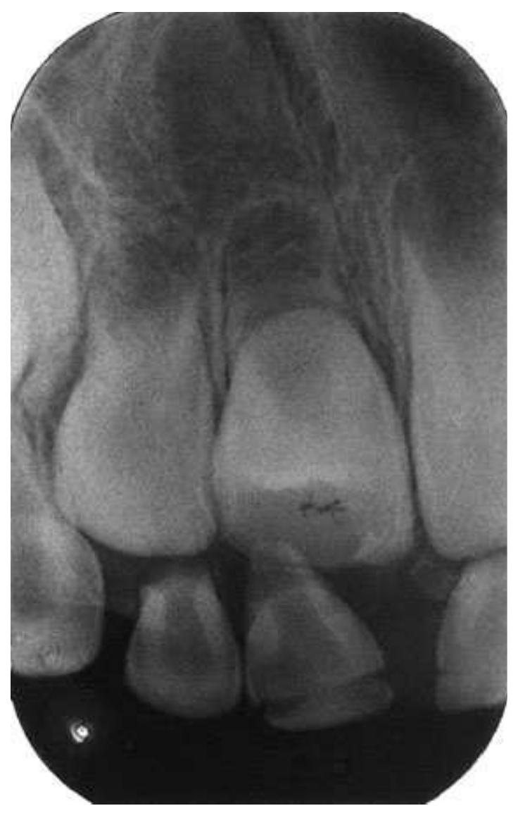 Initial periapical radiograph revealing the absence of