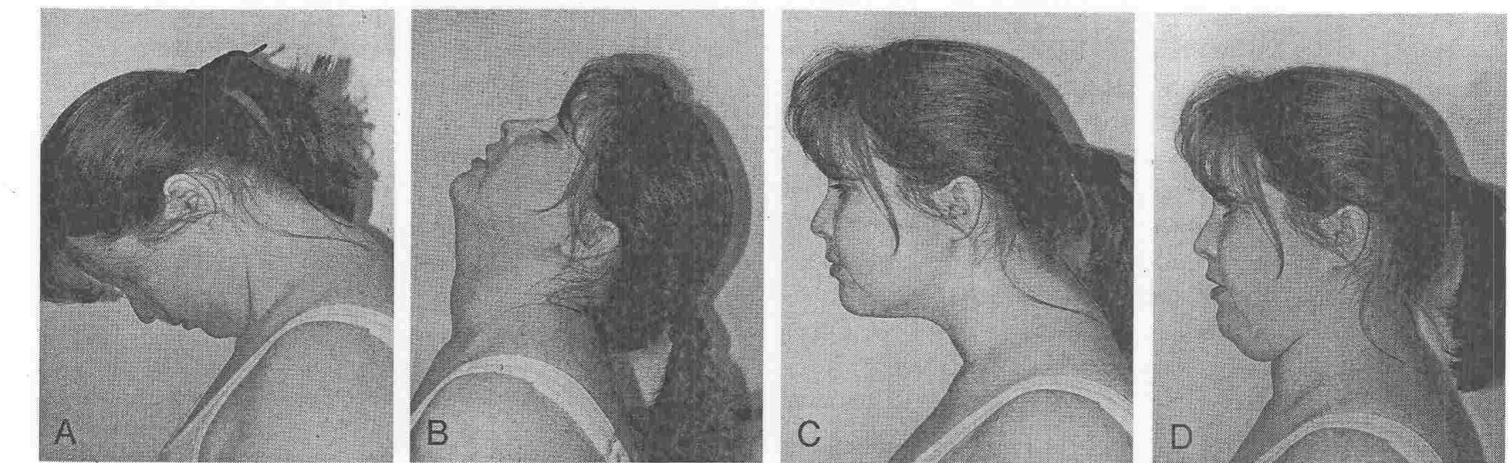 Four test positions: (a) flexion (chin-to-chest), (b)