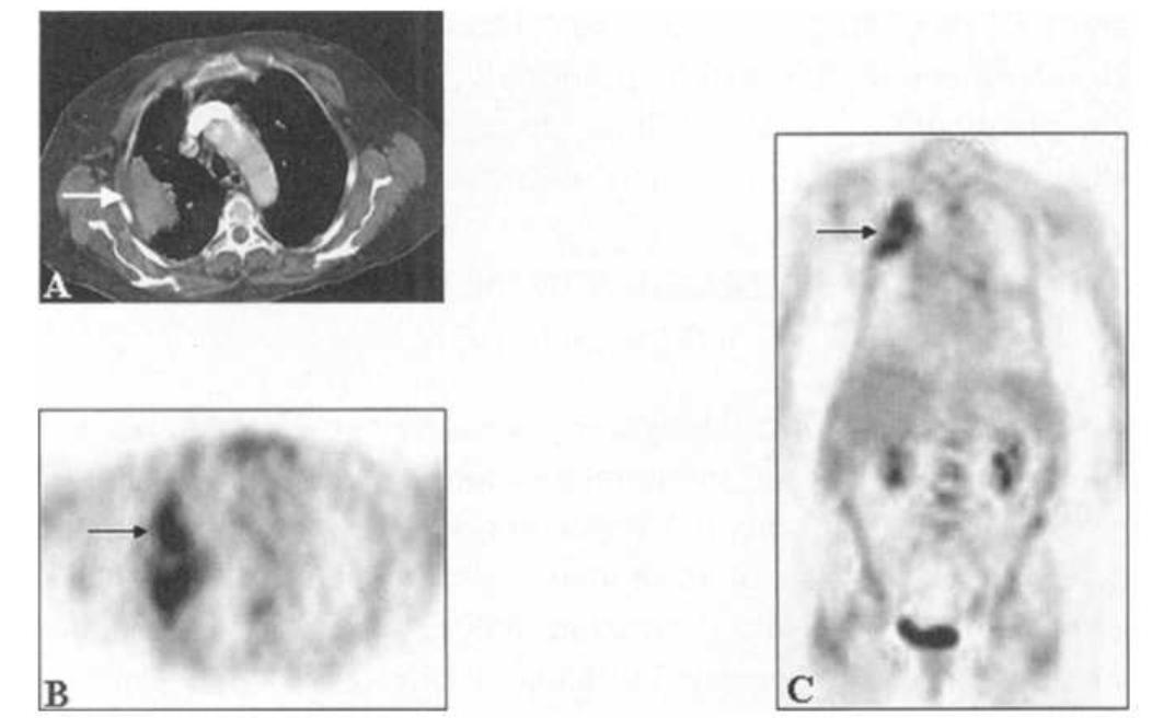The ct scan (a) revealed a pleural-based mass in the right