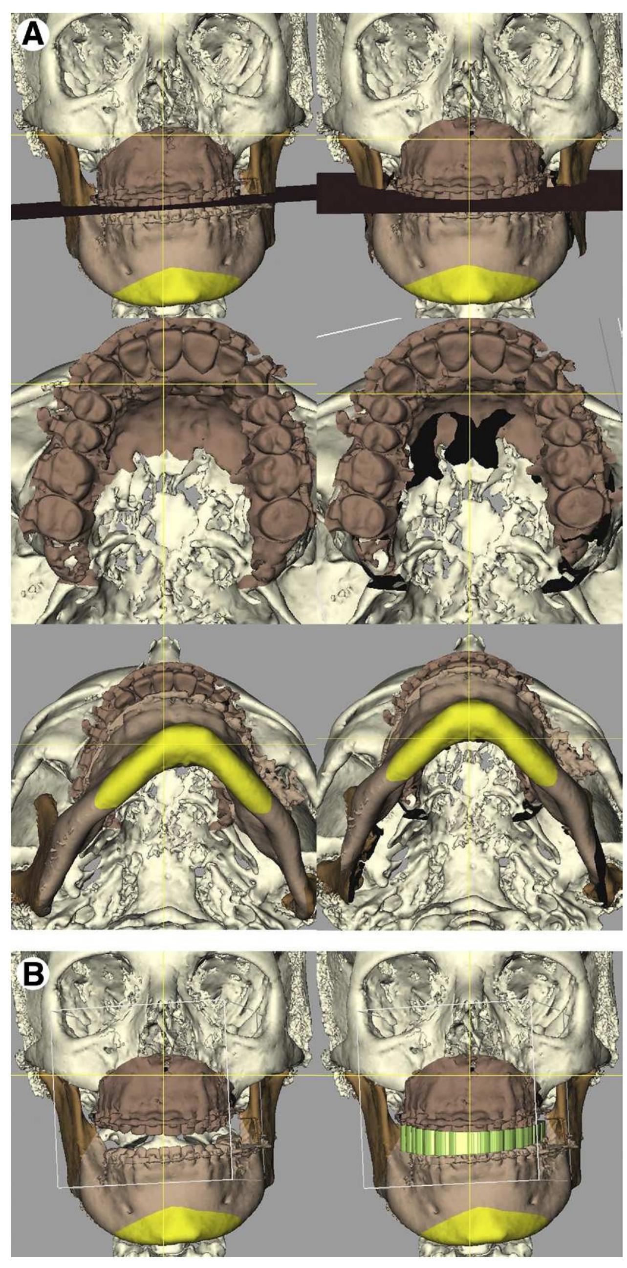 Virtual correction of occlusal plane tilting and upper