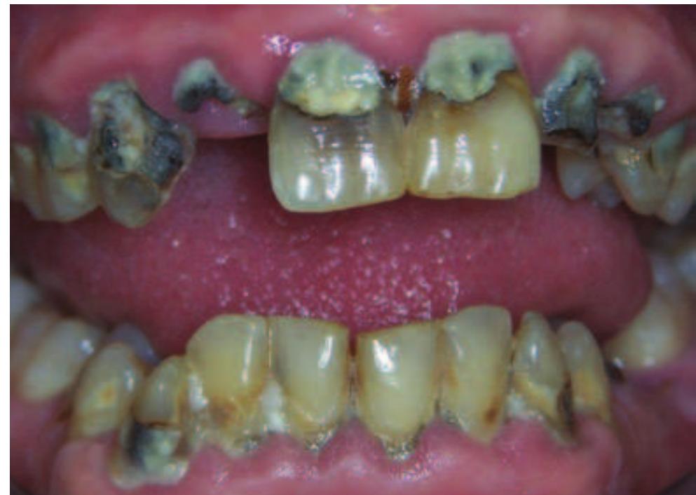 Intraoral photograph of a patient with meth mouth,