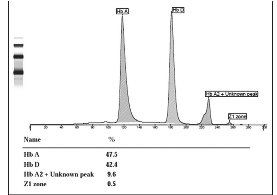 Capillary Zone Electrophoresis Pattern Indicates Peaks In Hb